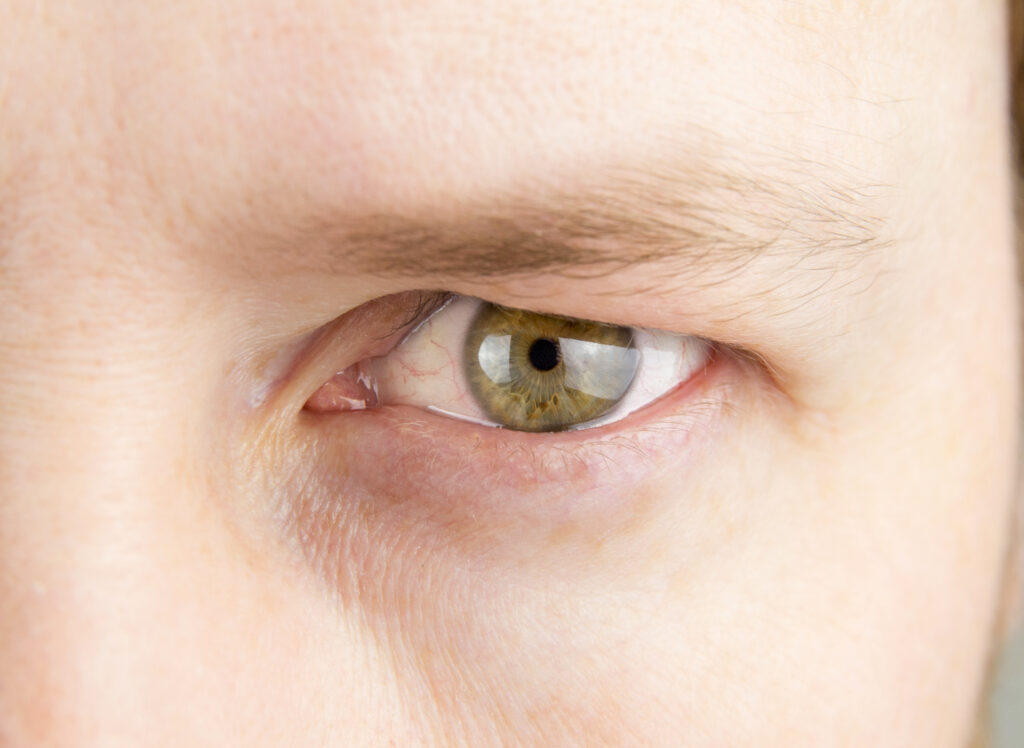 Opadająca Powieka - Porady Lekarskie, Recepty, Zwolnienia I Konsultacje ...